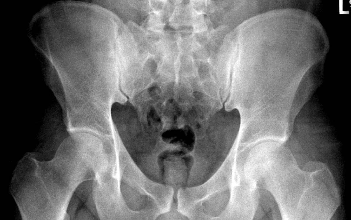 Radiographic Sacroiliitis