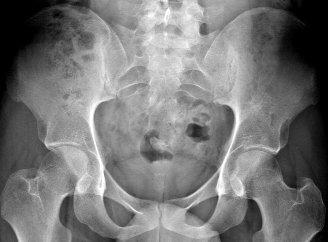 Radiographic Sacroiliitis