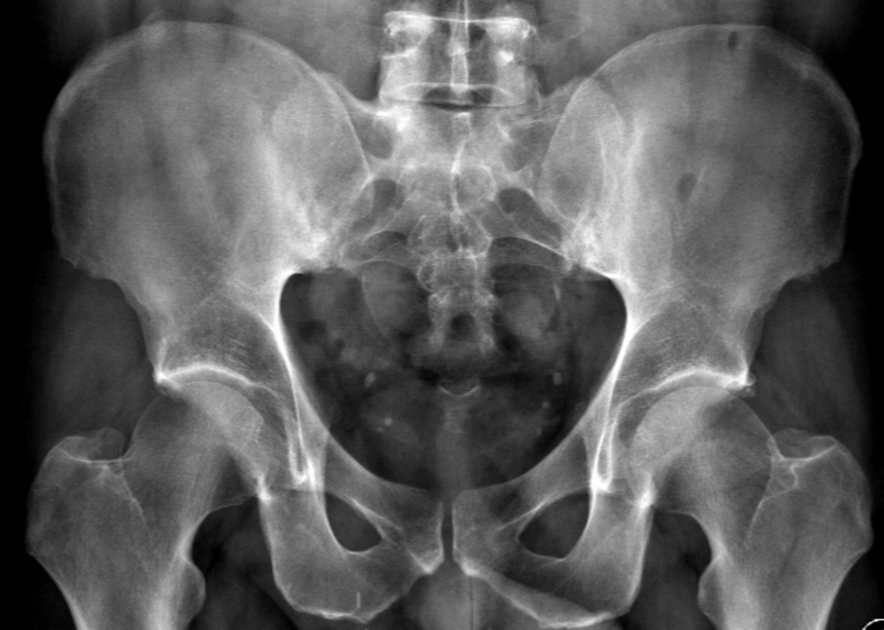Radiographic Sacroiliitis