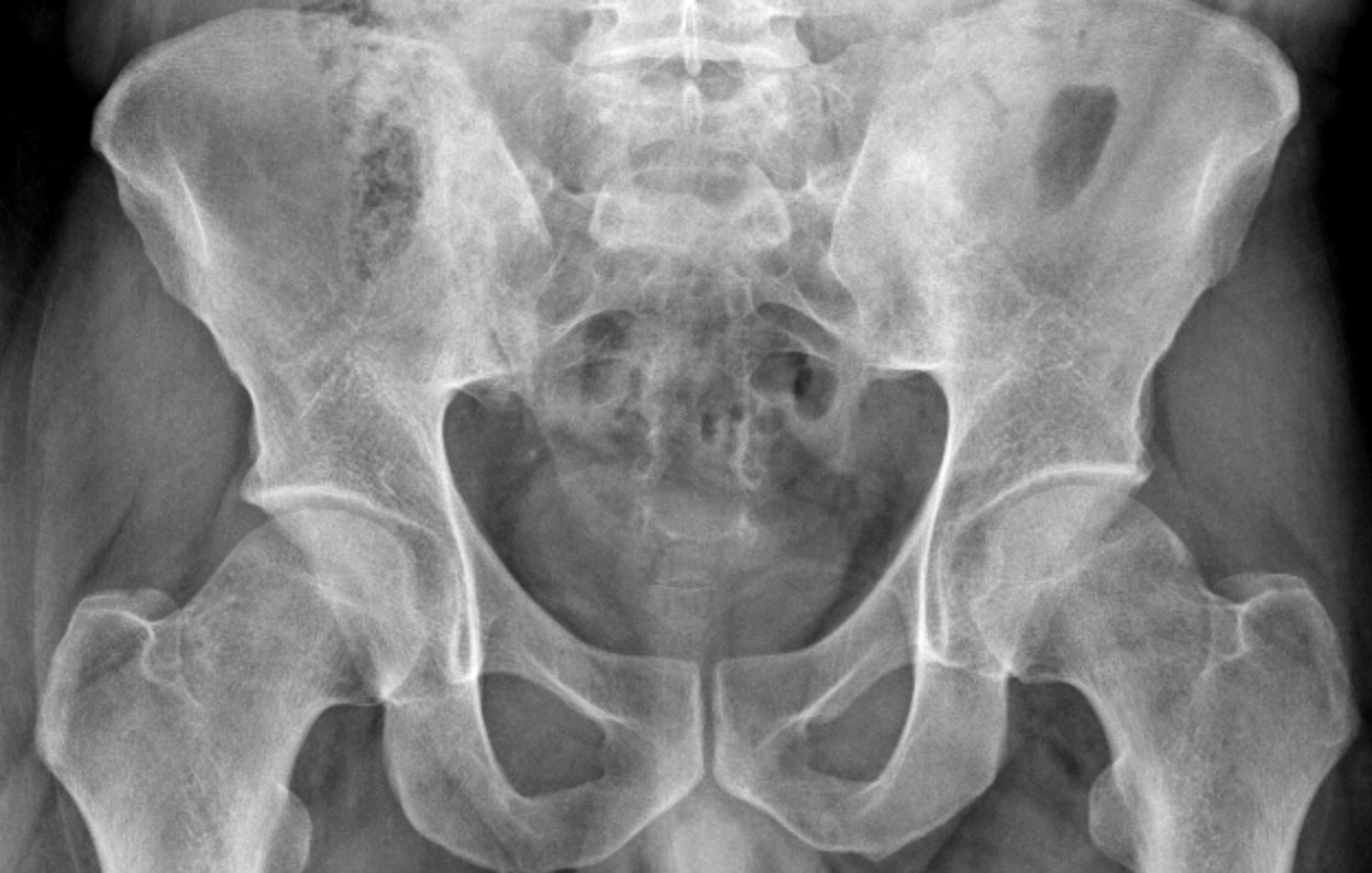 Radiographic Sacroiliitis